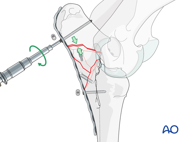 Plate fixation for Olecranon: Type 4 fractures