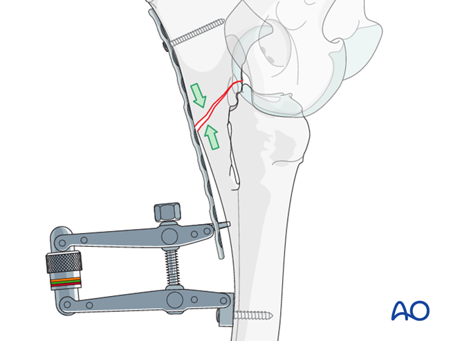 Plate fixation for Olecranon: Type 5 fractures