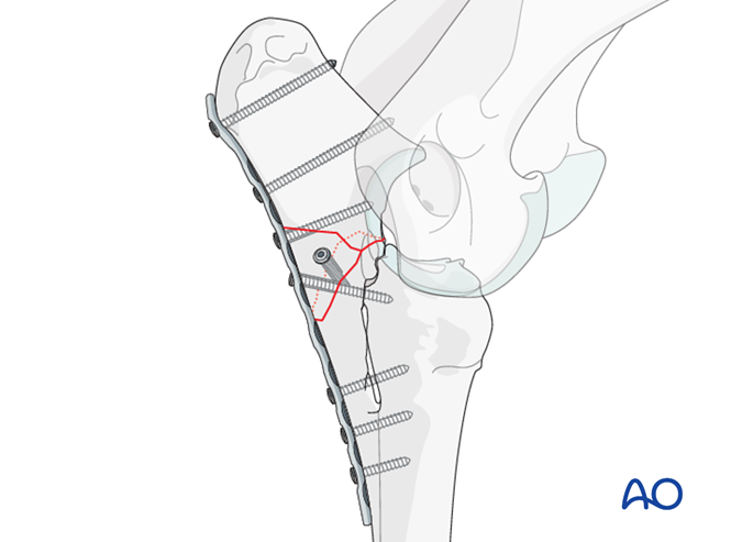 Plate fixation for Olecranon: Type 5 fractures