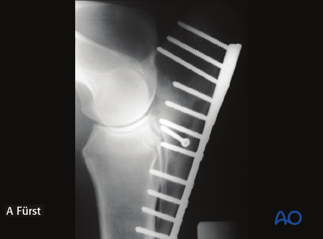 Plate fixation for Olecranon: Type 5 fractures