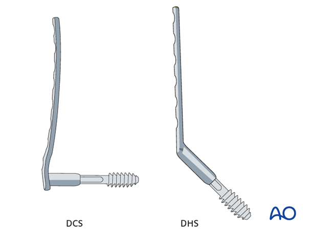 Double plating for Proximal physeal fractures: Salter-Harris type II
