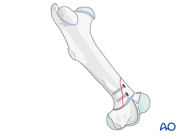 Double plating for Proximal physeal fractures: Salter-Harris type II