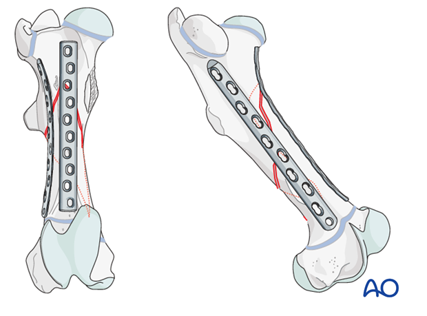 Double plating for Mid-diaphyseal spiraling fractures