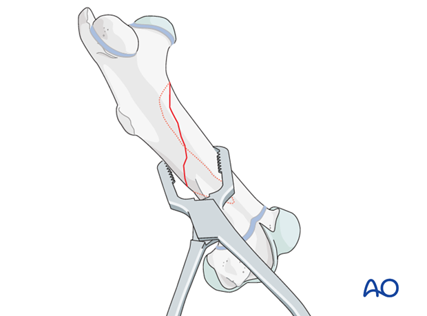 Double plating for Mid-diaphyseal spiraling fractures