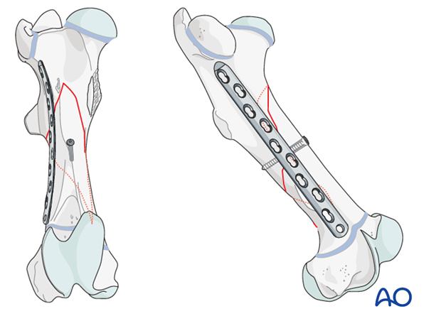 Double plating for Mid-diaphyseal spiraling fractures