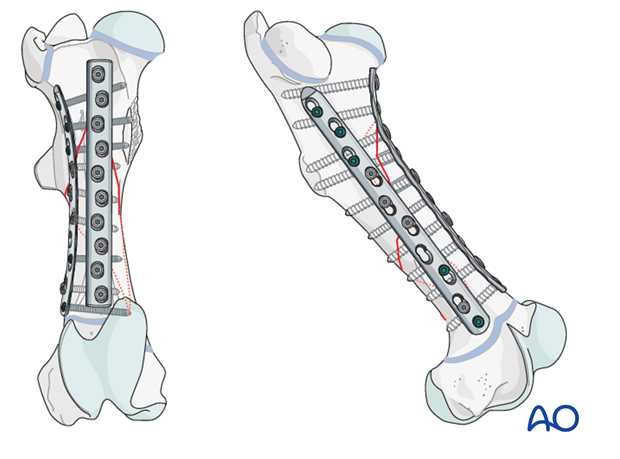 Double plating for Mid-diaphyseal spiraling fractures