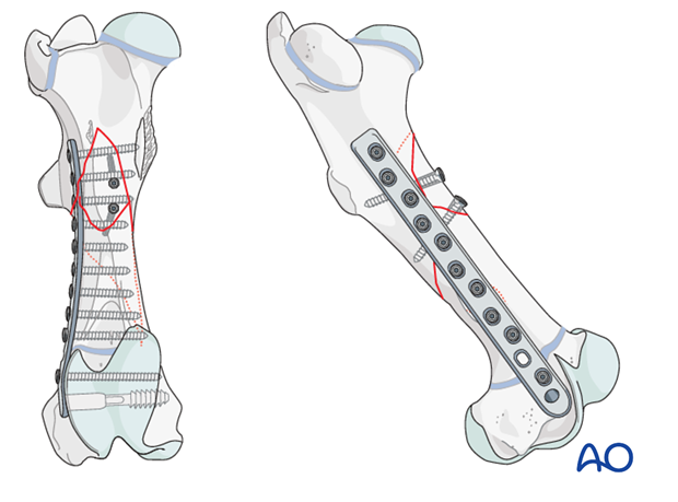 Double plating for Mid-diaphyseal spiraling fractures