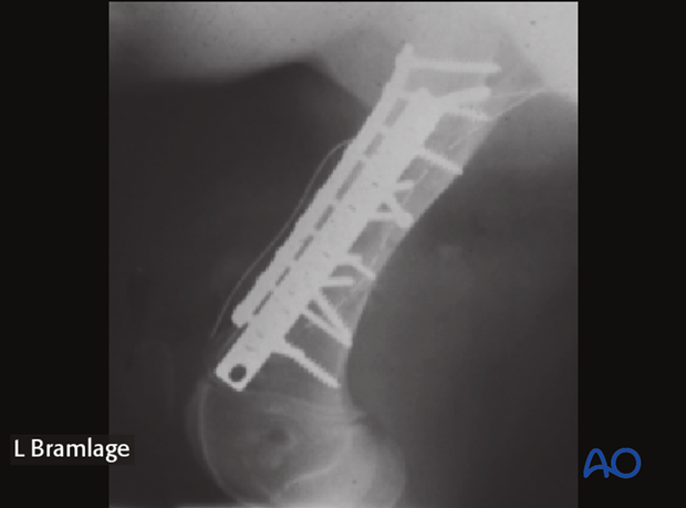 Double plating for Mid-diaphyseal spiraling fractures