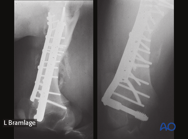 Double plating for Mid-diaphyseal spiraling fractures