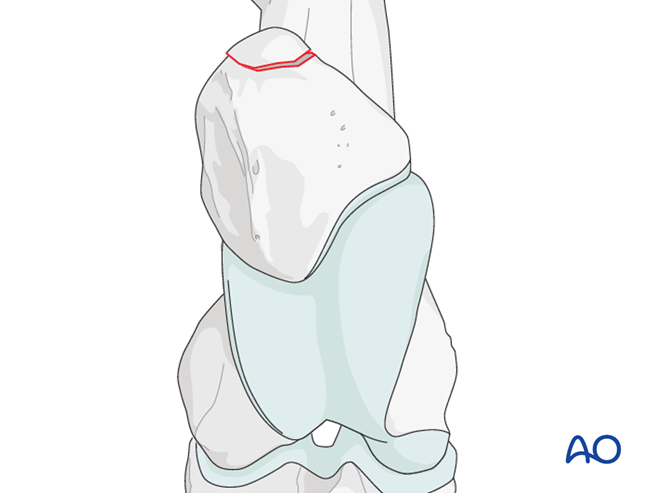 Resection for Apical fractures