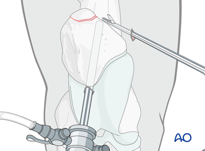 Arthroscopic approach for equine patellar fractures