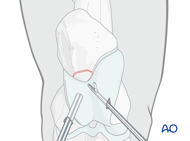 Arthroscopic approach for equine patellar fractures