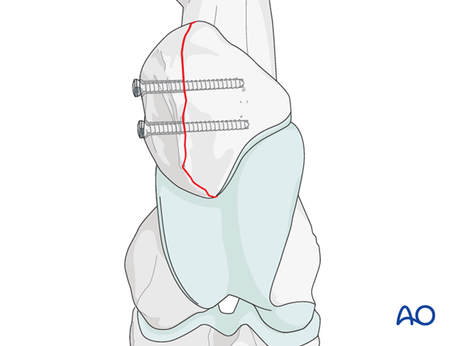 Screw fixation for Sagittal fractures