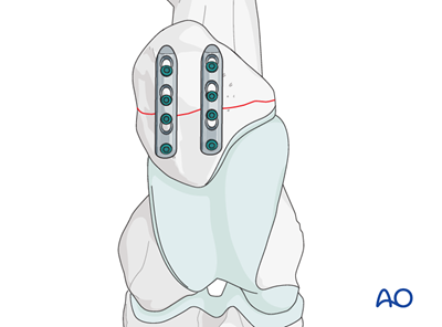 Screw/Plate fixation for Transverse fractures