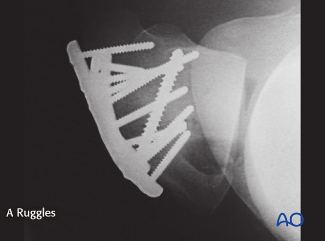 Screw/Plate fixation for Transverse fractures