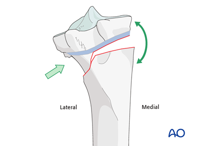 Proximal physeal fractures, Salter-Harris type II