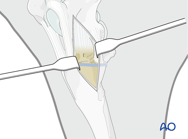 Approach to the equine proximal tibia