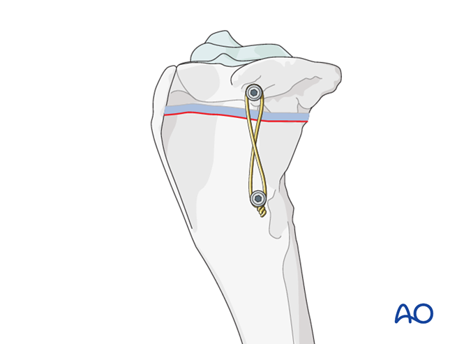 Plate Fixation for Proximal physeal fractures, Salter-Harris type II