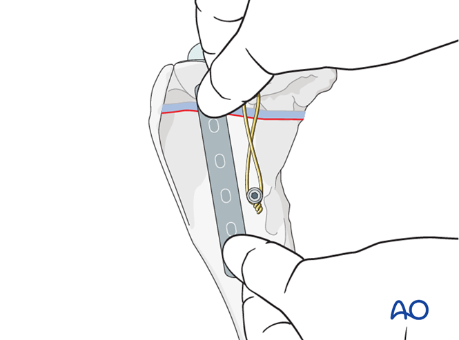 Plate Fixation for Proximal physeal fractures, Salter-Harris type II