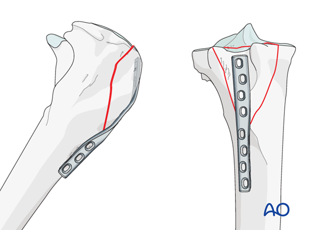 Plate fixation for Tibial crest physeal fractures