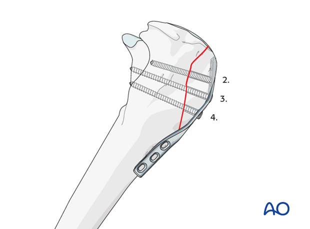 Plate fixation for Tibial crest physeal fractures