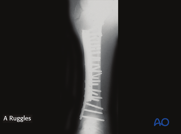 Double plating for Simple diaphyseal fractures