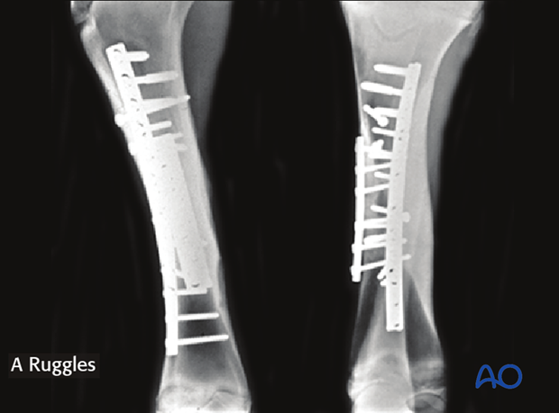 Double plating for Simple diaphyseal fractures
