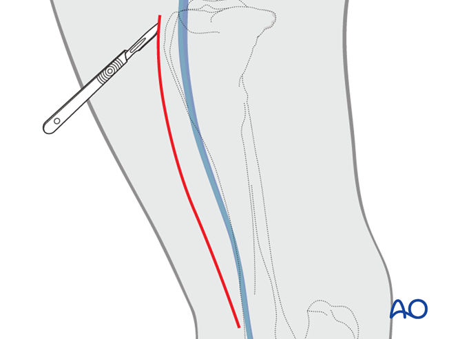 Medial approach to tibial shaft