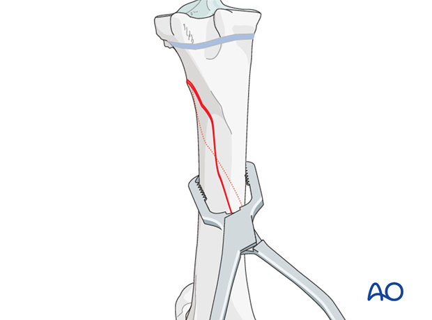 Double plating for Simple diaphyseal fractures