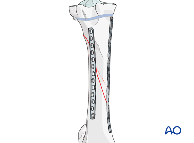 Double plating for Simple diaphyseal fractures