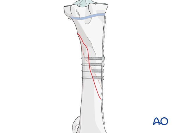 Double plating for Simple diaphyseal fractures