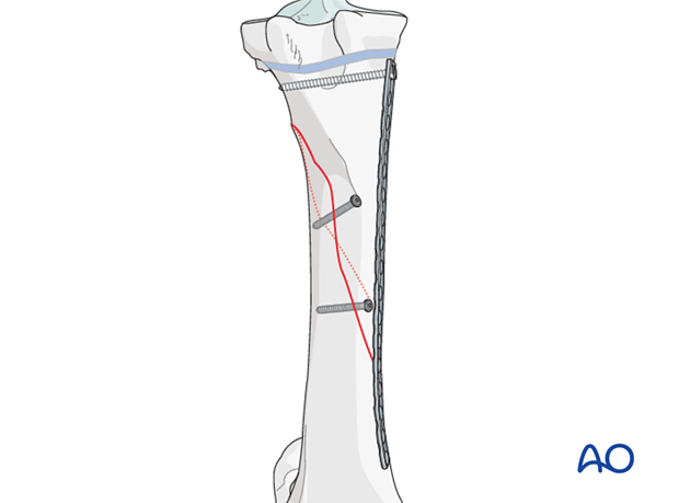 Double plating for Simple diaphyseal fractures