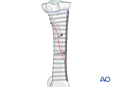Double plating for Simple diaphyseal fractures