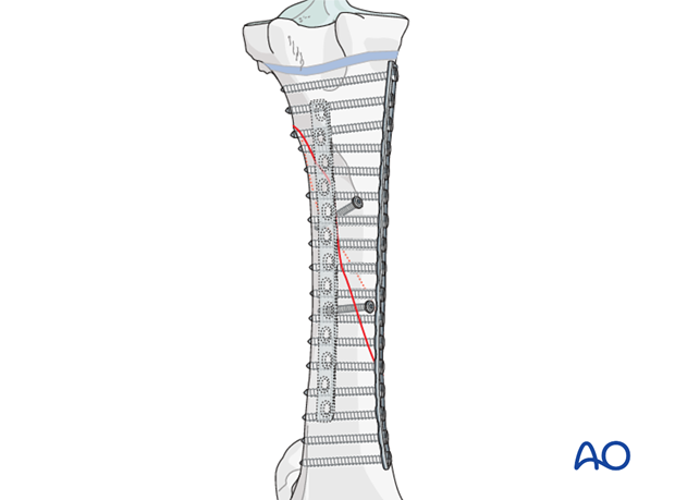Double plating for Simple diaphyseal fractures