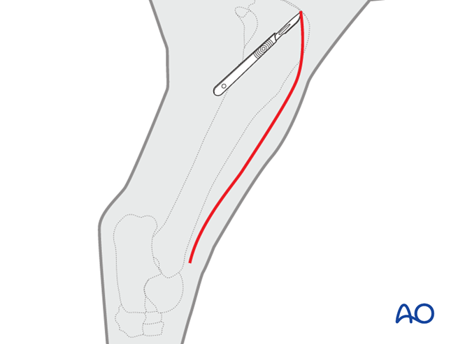 Lateral approach to tibial shaft