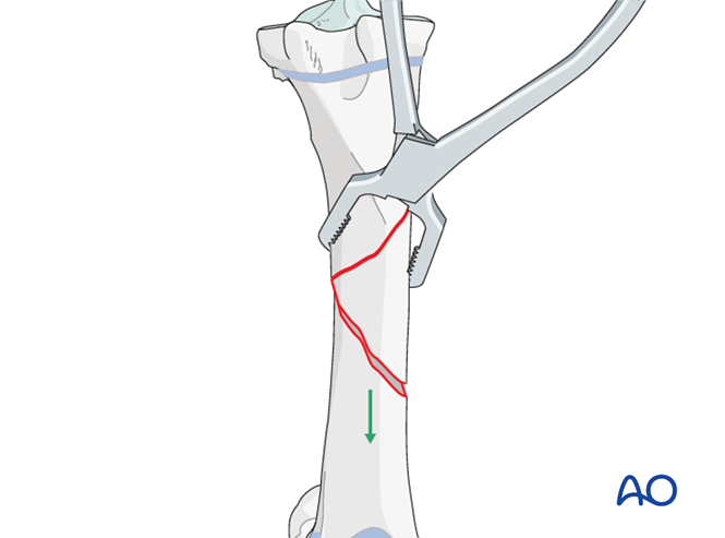 Double plating for Comminuted diaphyseal fractures