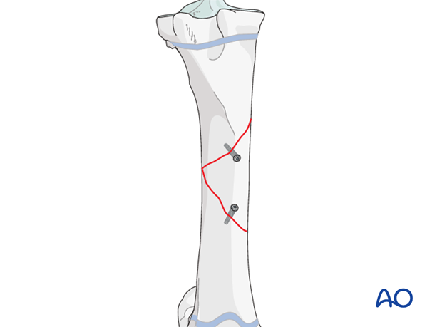 Double plating for Comminuted diaphyseal fractures