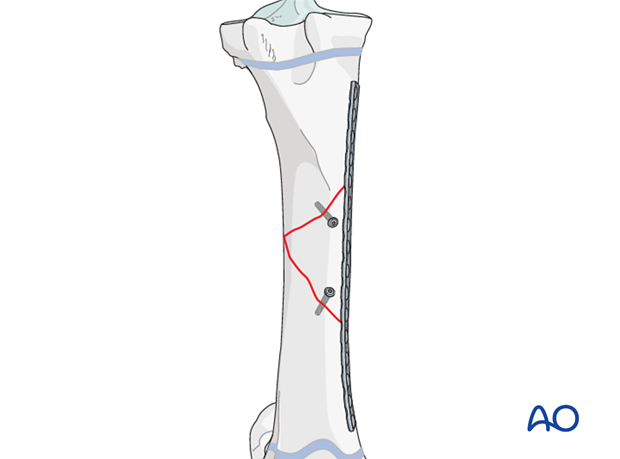 Double plating for Comminuted diaphyseal fractures