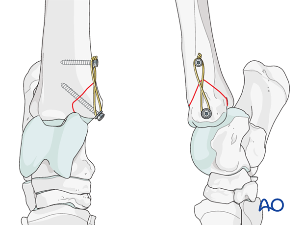 Tension band for Medial malleolar fractures