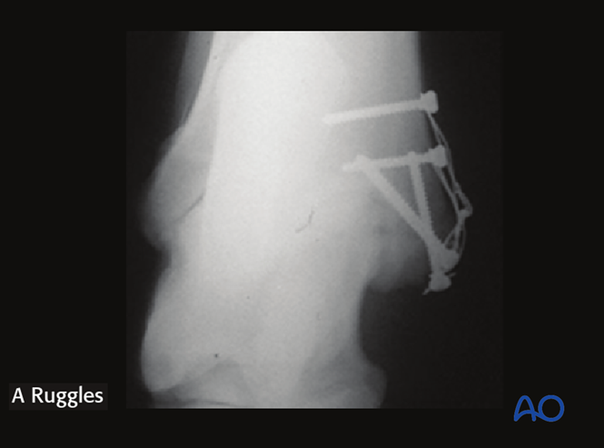 Tension band for Medial malleolar fractures
