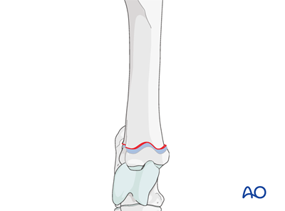 Distal physeal fractures