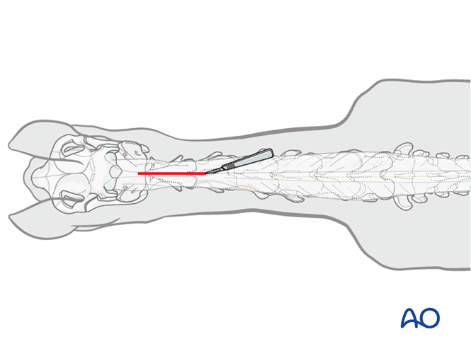 Dorsal midline approach to the equine cervical spine
