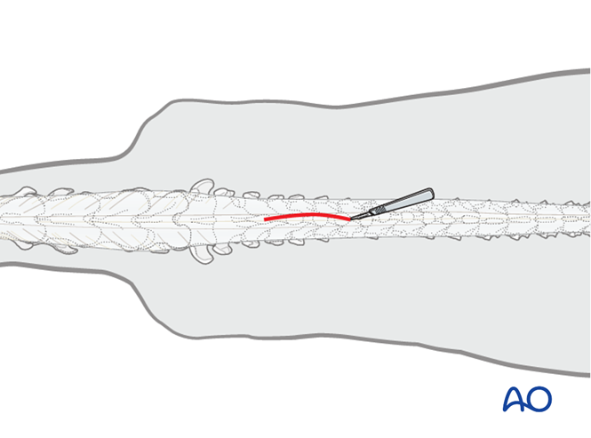 Dorsal midline approach to the dorsal spinous process