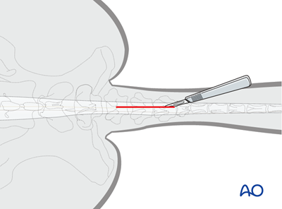 Resection for Coccygeal fractures
