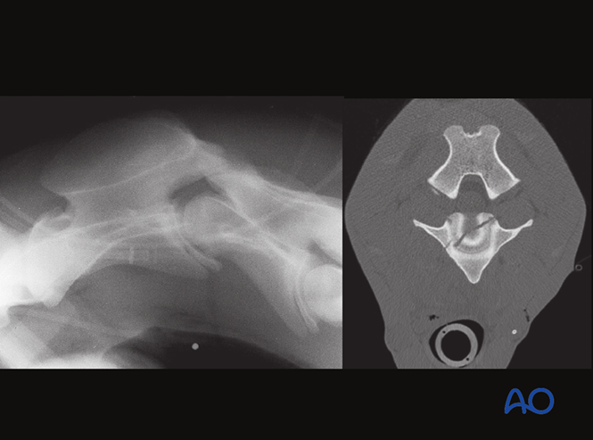 C1 (Atlas) fractures
