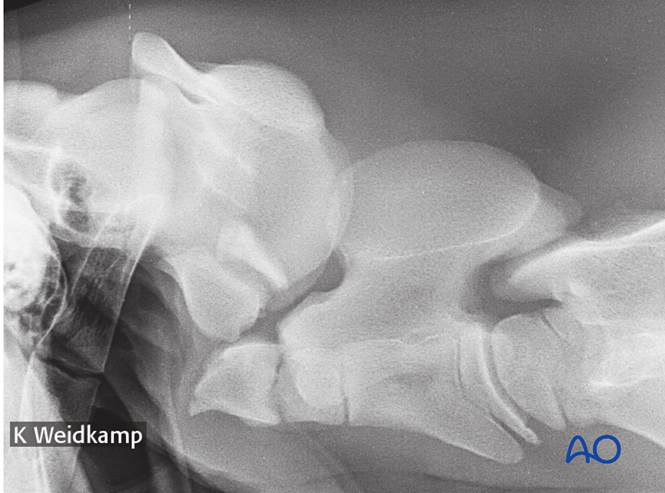 C2 (Axis) dens fractures