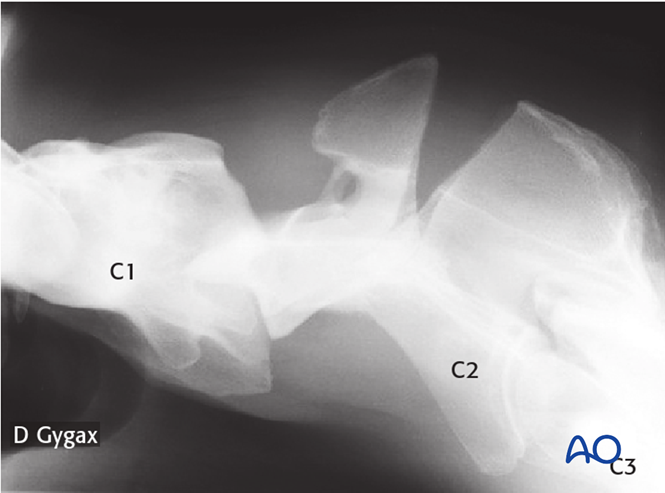 C2 (Axis) body fractures