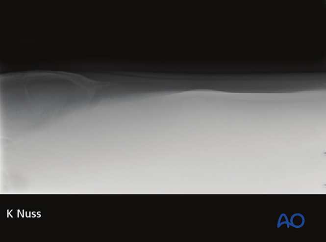 Sacral fractures