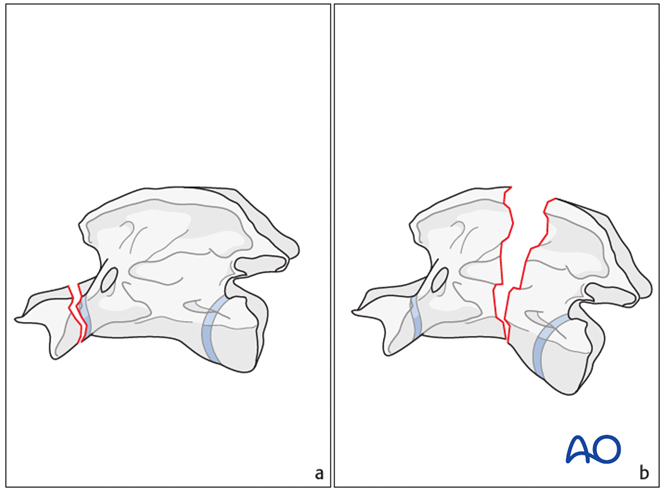 Plate fixation (dorsally) for C2 (Axis) body fractures