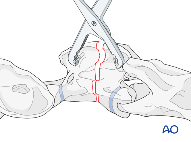 Plate fixation (dorsally) for C2 (Axis) body fractures